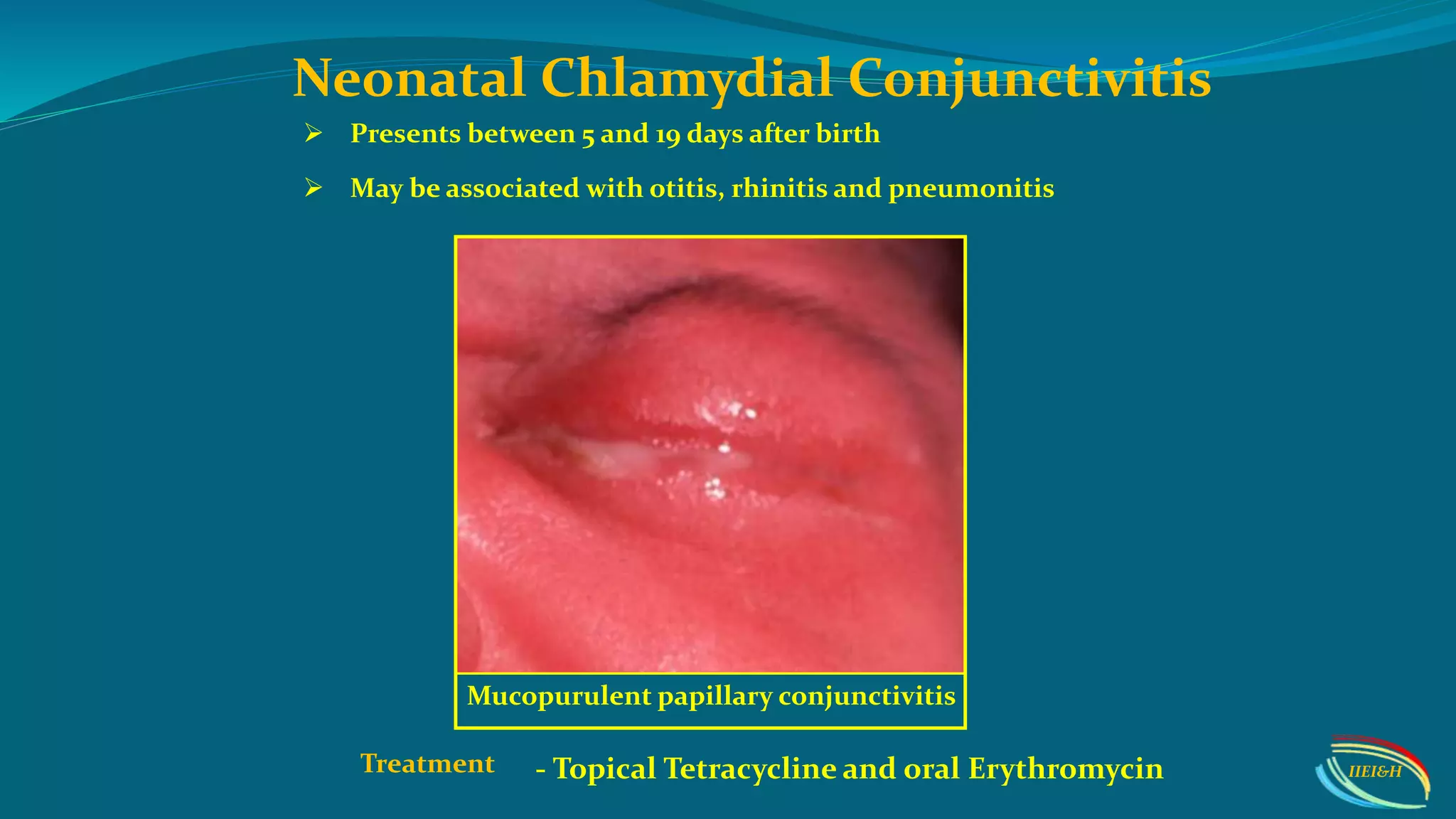 Conjunctivitis | PPTX
