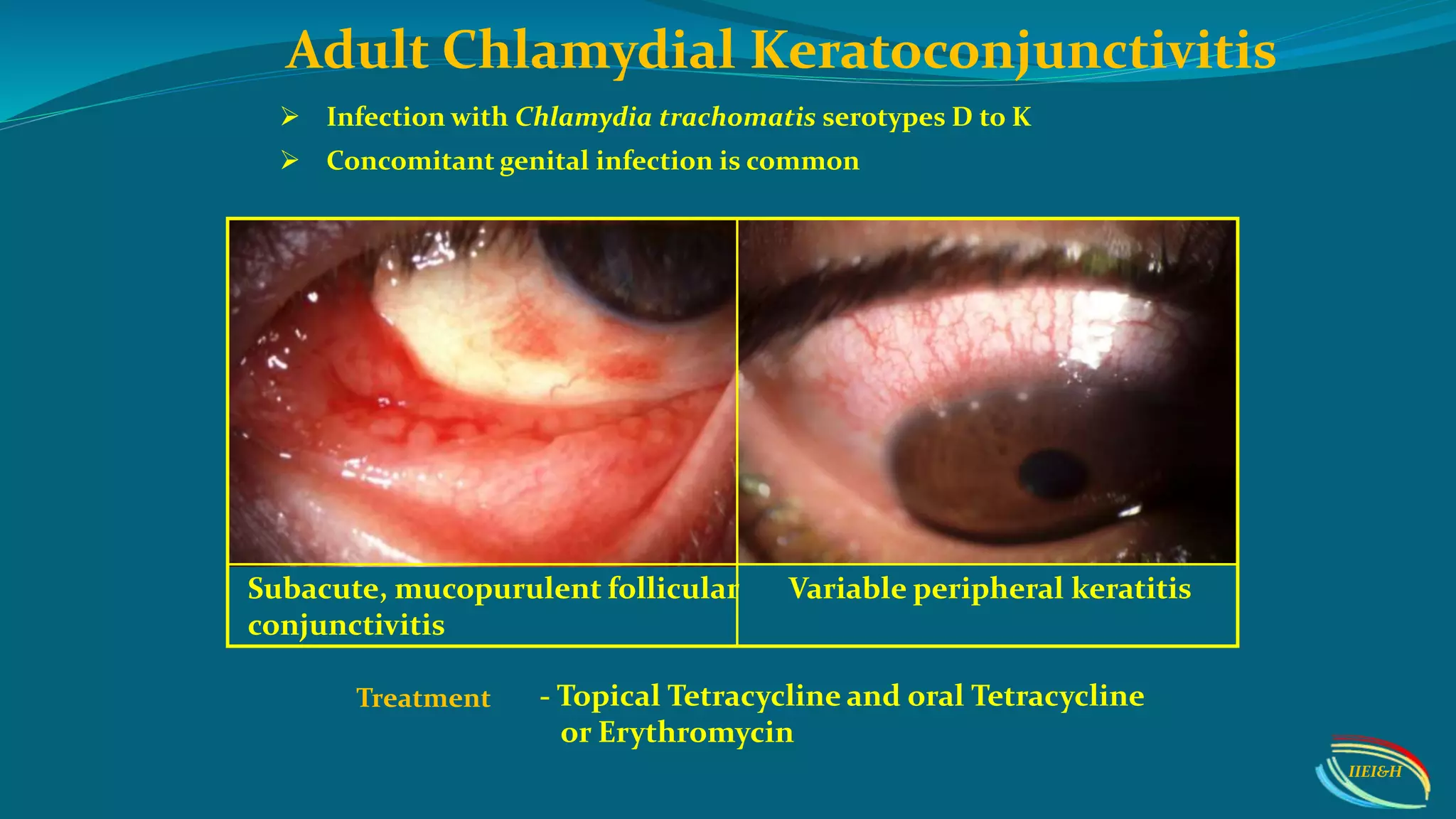 Conjunctivitis | PPTX
