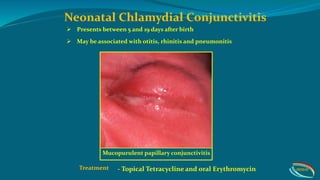 Conjunctivitis | PPTX