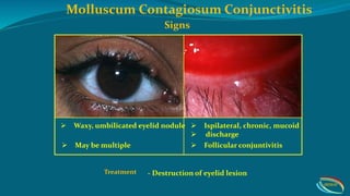 Conjunctivitis | PPTX