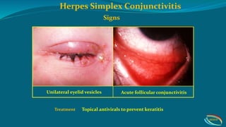 Conjunctivitis | PPTX