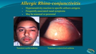 Conjunctivitis | PPTX