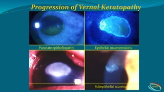 Conjunctivitis | PPTX