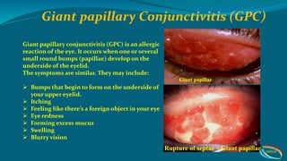 Conjunctivitis | PPTX