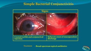 Conjunctivitis | PPTX
