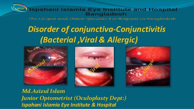 Limbic Sparing Conjunctivitis
