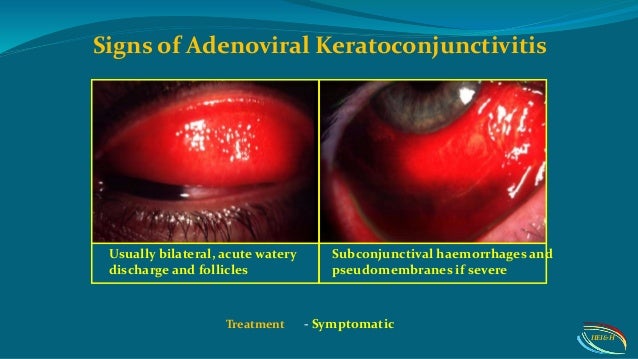 Conjunctivitis