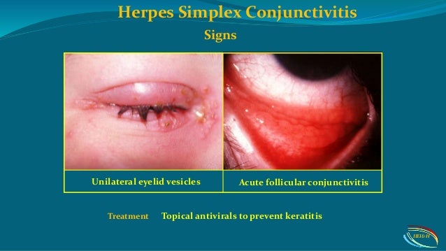 Conjunctivitis
