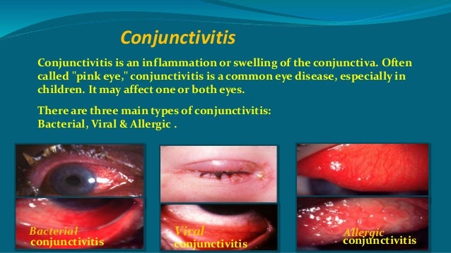 Conjunctivitis