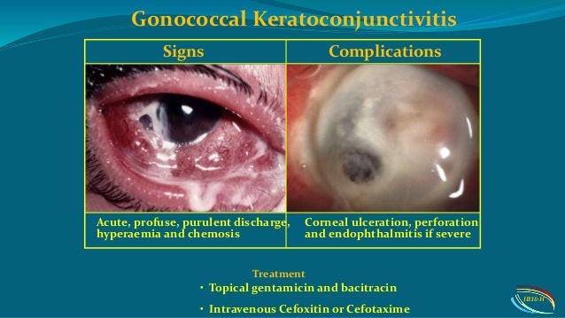 Conjunctivitis