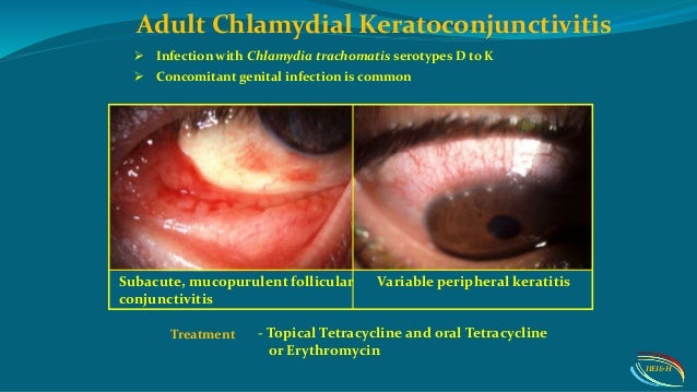 Conjunctivitis