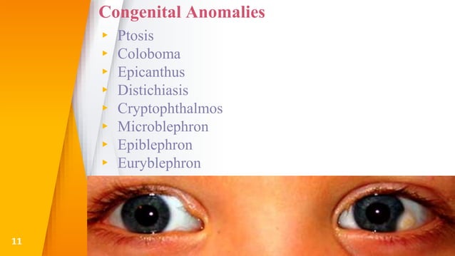 Eye Lid Disorders ,Ophthalmology | PPTX | Eye and Vision Conditions ...