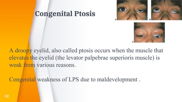Eye Lid Disorders ,Ophthalmology | PPTX | Eye and Vision Conditions ...