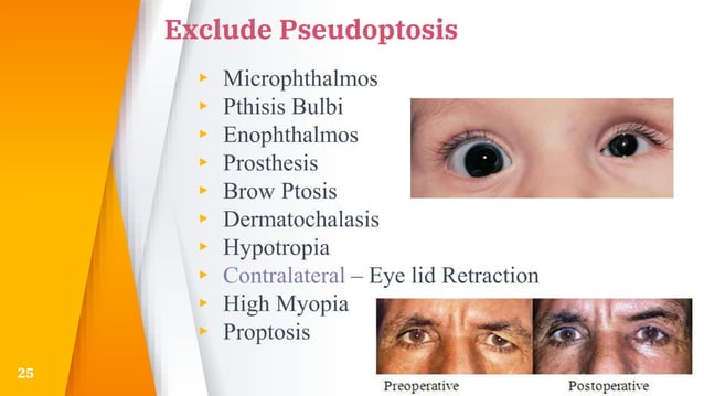 Eye Lid Disorders ,Ophthalmology | PPTX | Eye and Vision Conditions ...