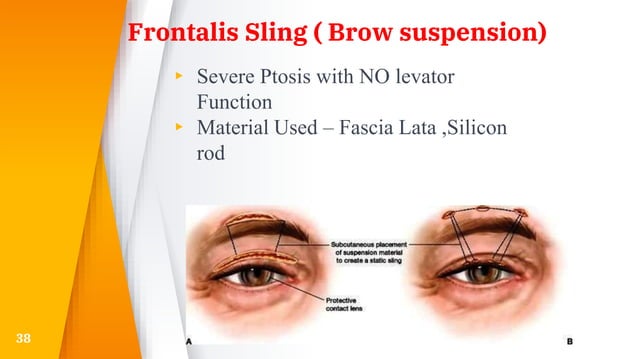 Eye Lid Disorders ,Ophthalmology | PPTX | Eye and Vision Conditions ...