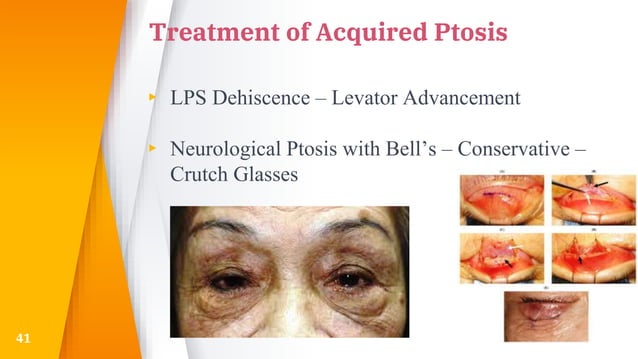 Eye Lid Disorders ,Ophthalmology | PPTX | Eye and Vision Conditions ...