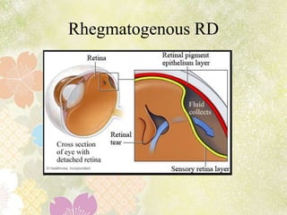 Disorder of retina | PPTX