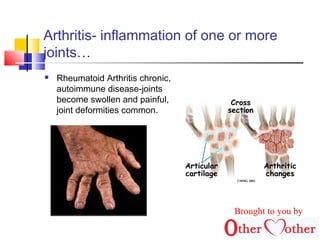 Disorder of the bones and joints… | PPT