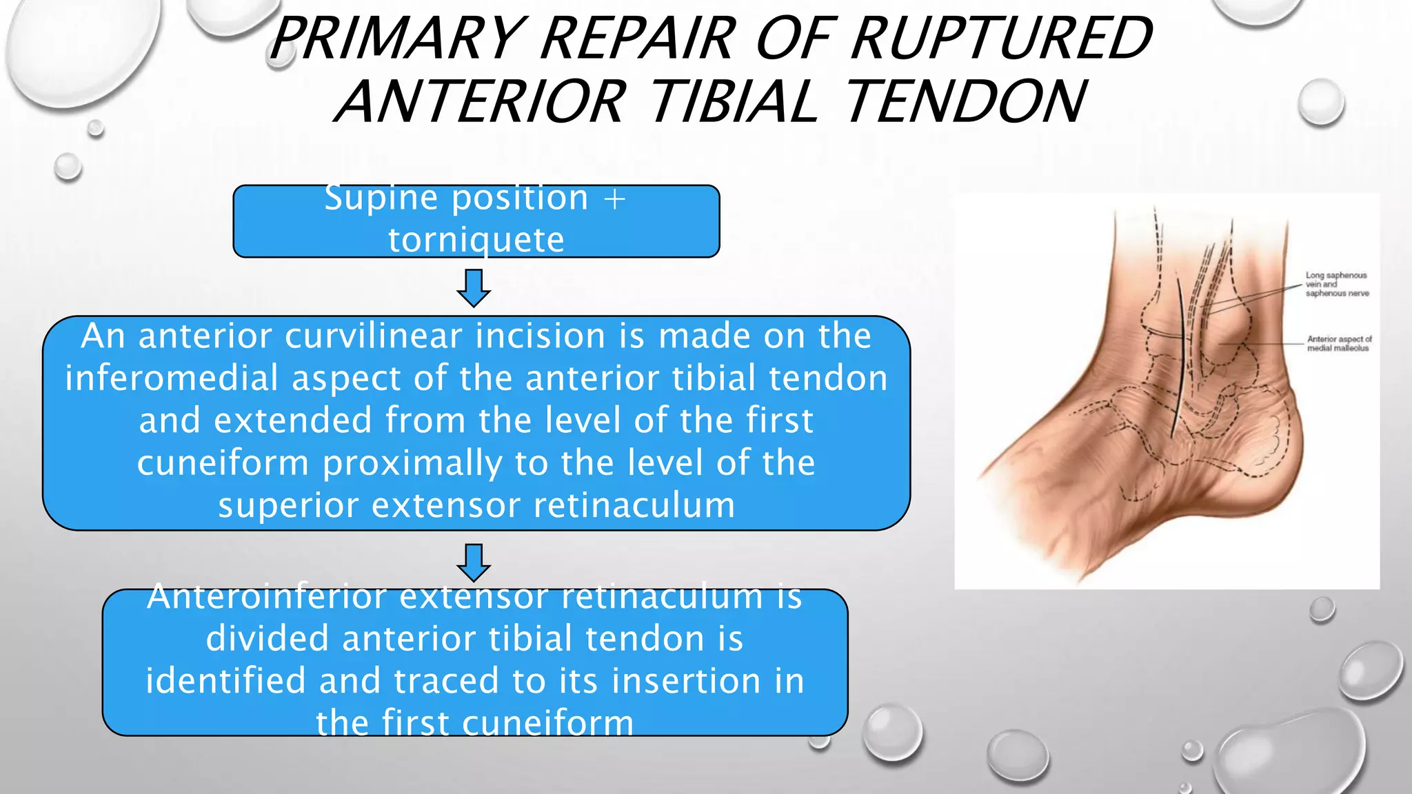 Disorder of tibialis anterior and tibialis posterior tendon | PPTX ...