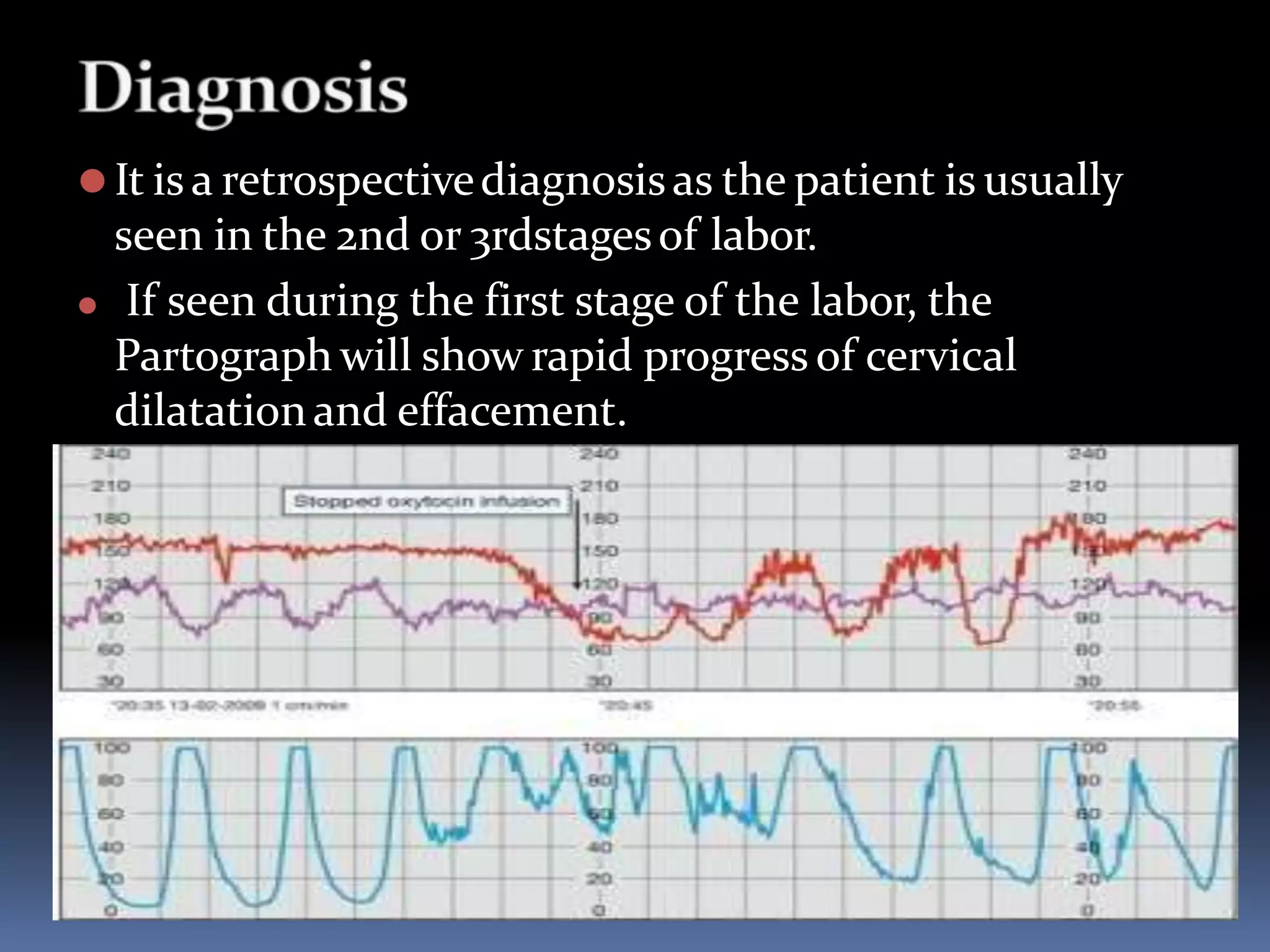 Disorder of uterine contraction & precipitate labour.pptx