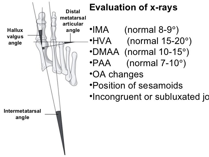 Disorders Of The Hallux