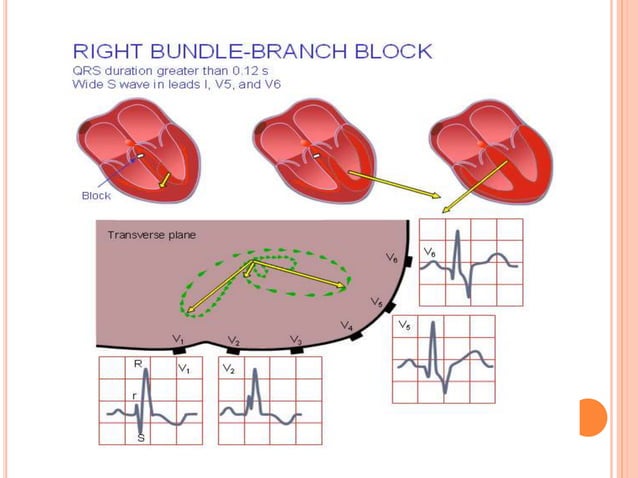 Disorders identified from ECG analysis | PPT