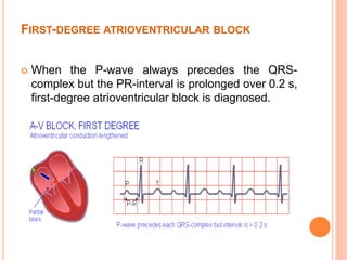 Disorders identified from ECG analysis | PPT