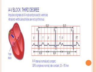 Disorders identified from ECG analysis | PPT