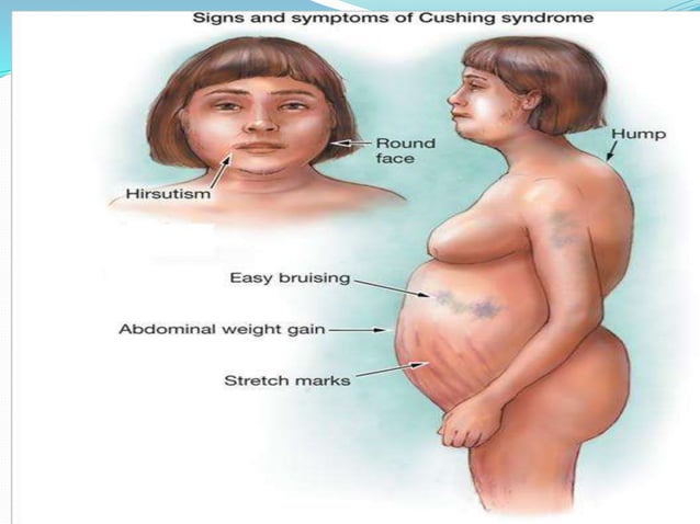 Disorders Of Adrenal Gland Ppt