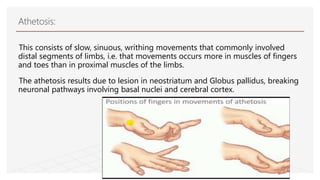 Disorders of basal nuclei | PPT