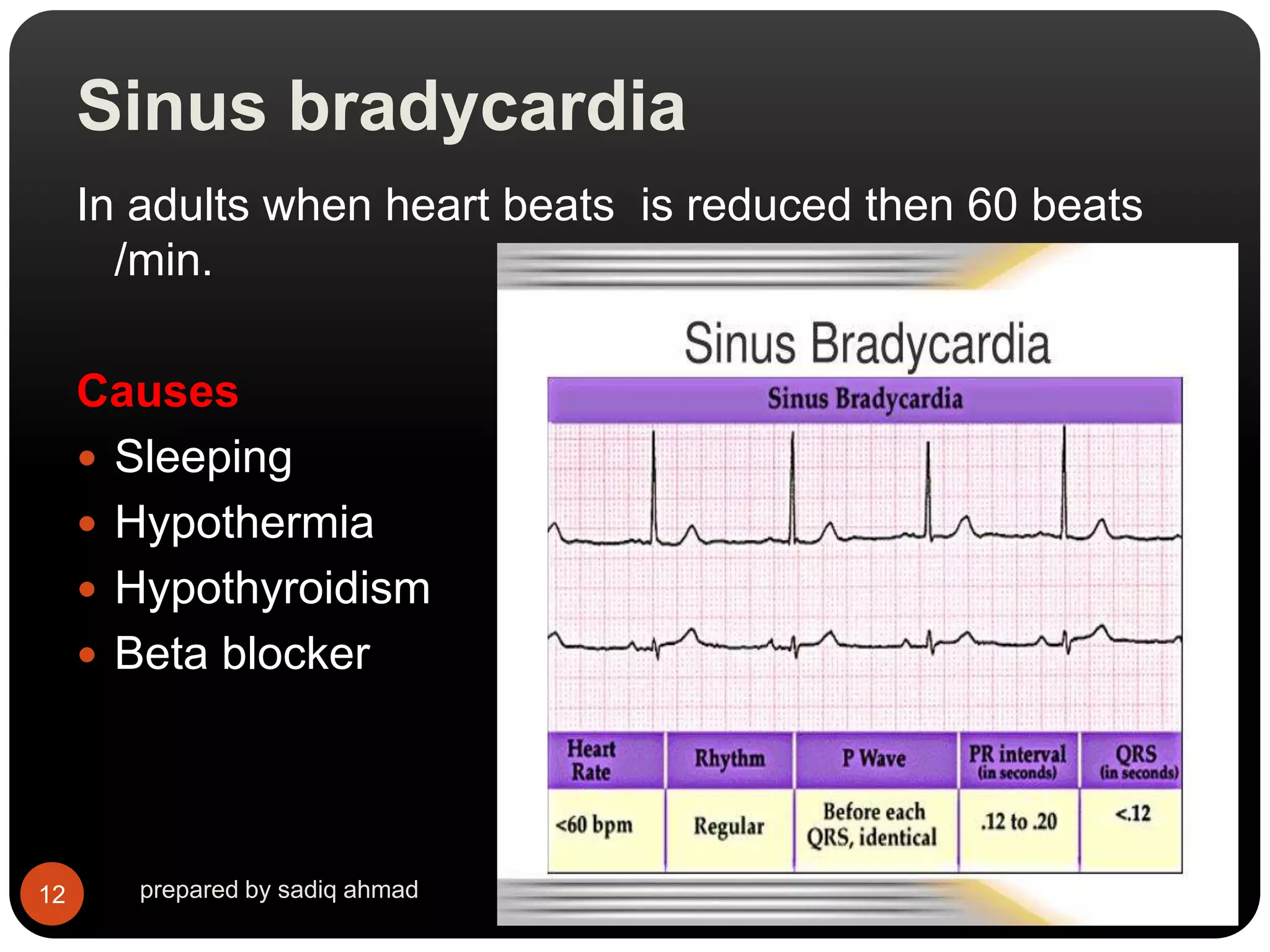 Disorders of cardiac conduction+heat blocks+pacemaker | PPTX