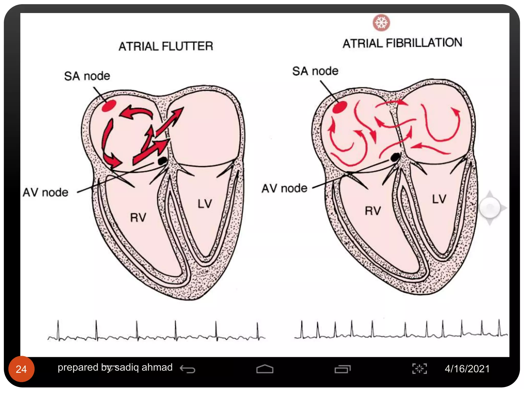 Disorders of cardiac conduction+heat blocks+pacemaker | PPTX