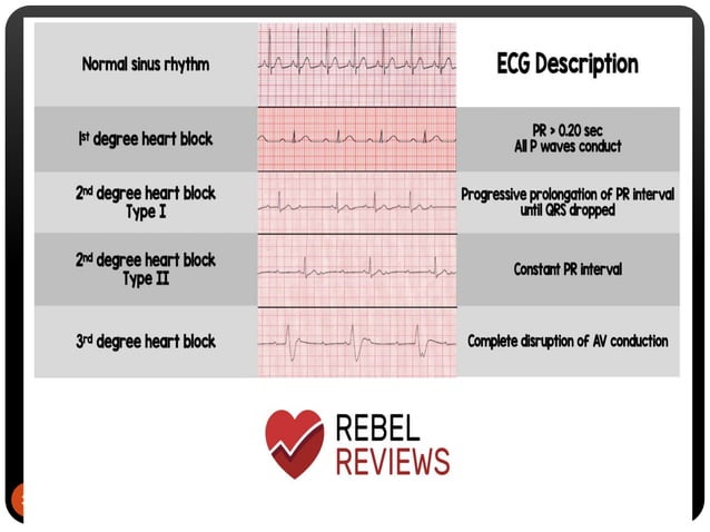 Disorders of cardiac conduction+heat blocks+pacemaker | PPT