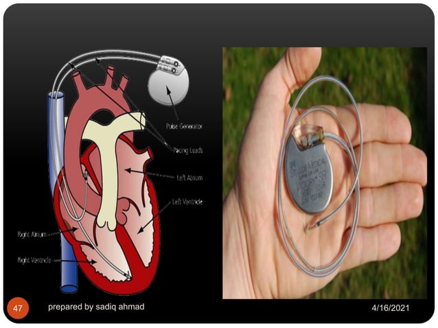 Disorders of cardiac conduction+heat blocks+pacemaker | PPT