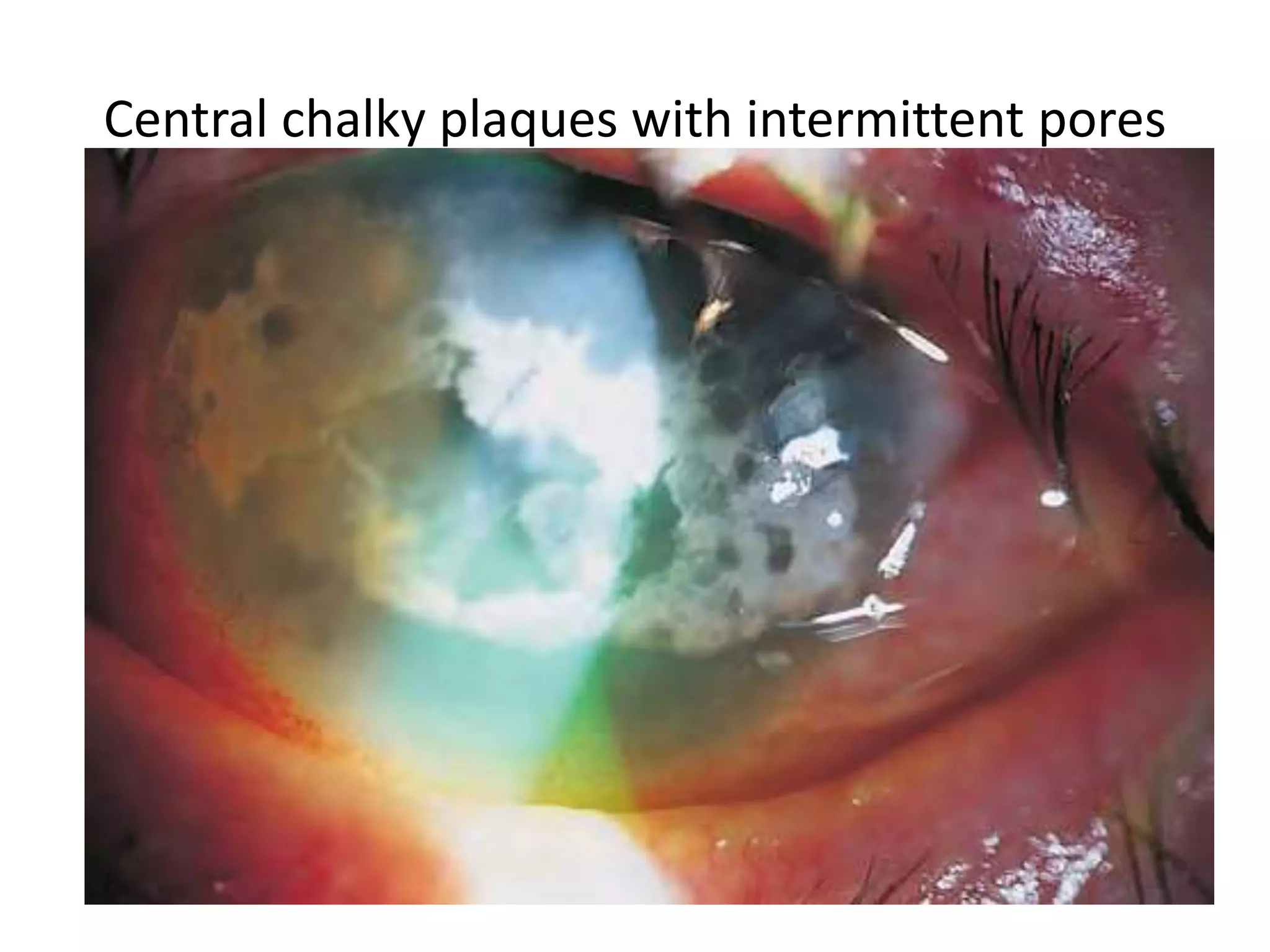 Disorders of cornea: Ectatic Disorders, Corneal Dystrophy and ...