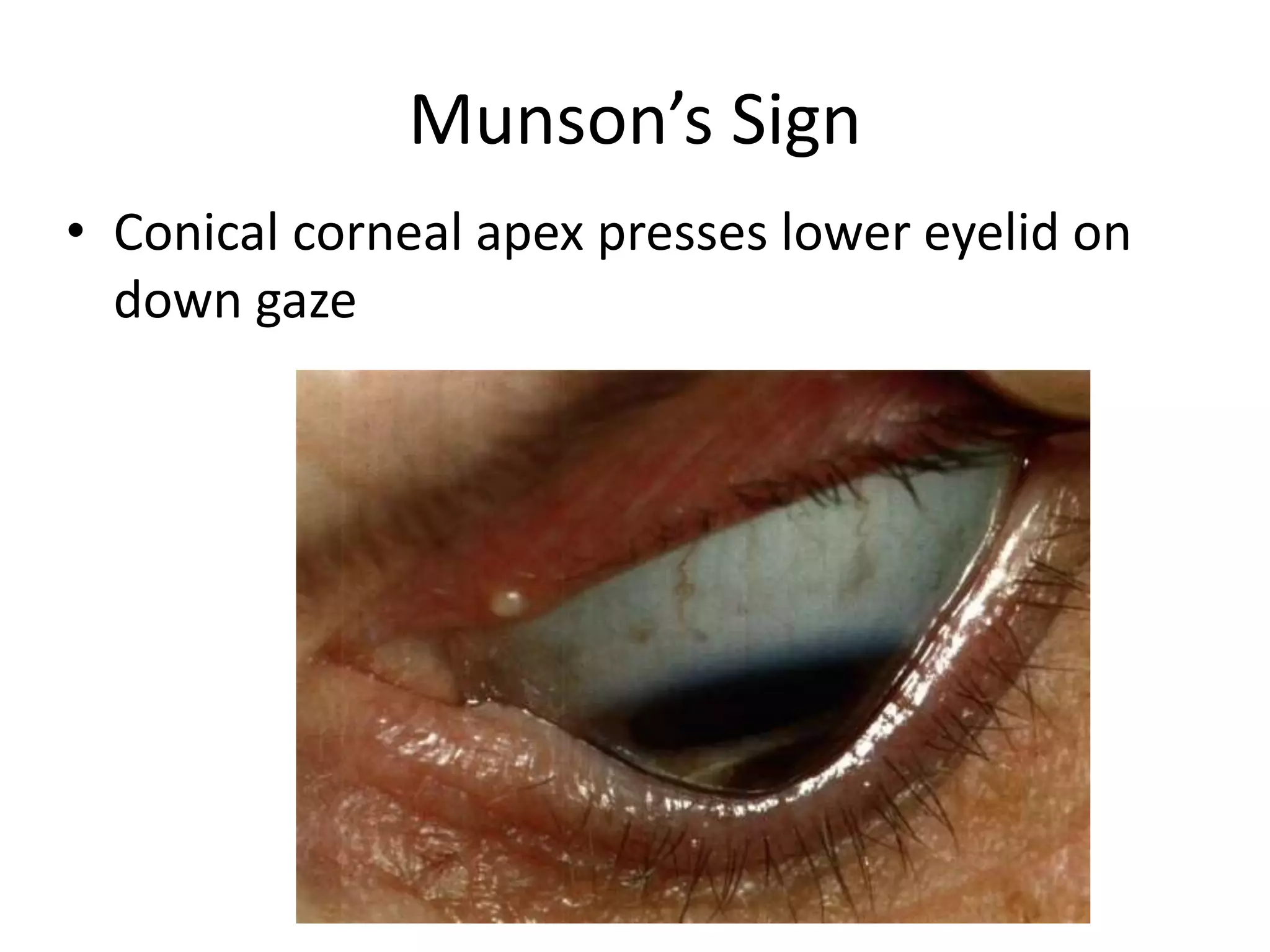 Disorders of cornea: Ectatic Disorders, Corneal Dystrophy and ...