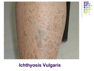 Ichthyoses and Ichthyosiform disorders | PPT