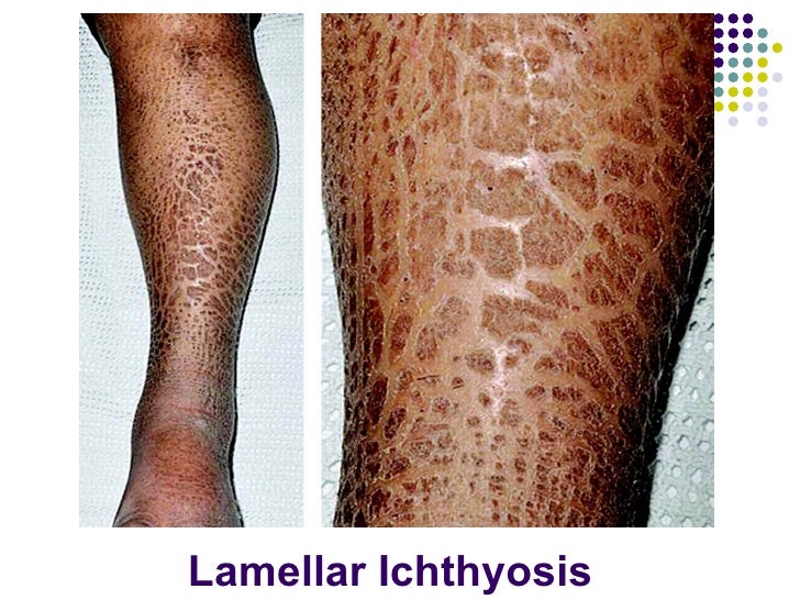 Ichthyoses And Ichthyosiform Disorders