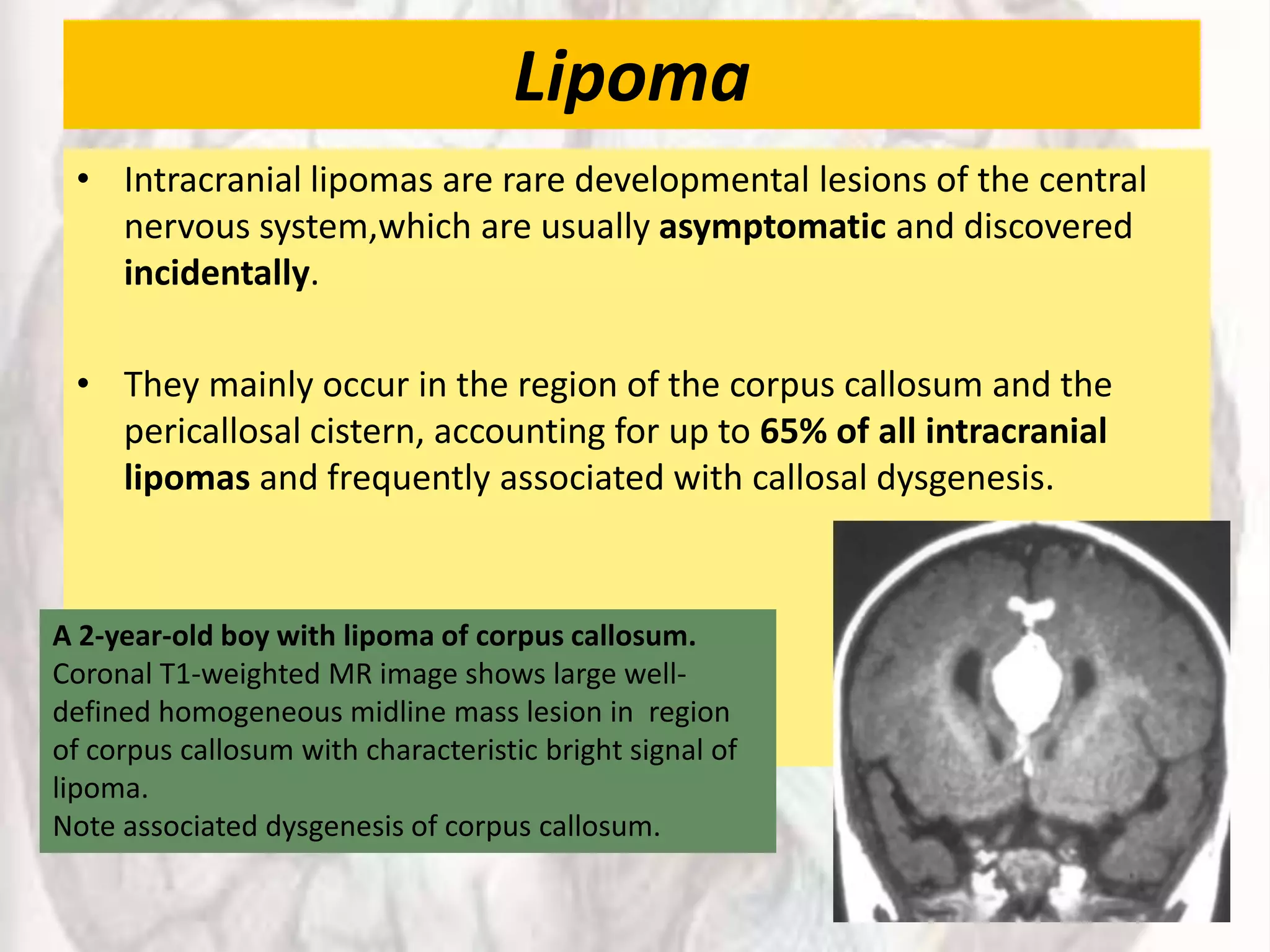 Disorders of corpus callosum | PPTX