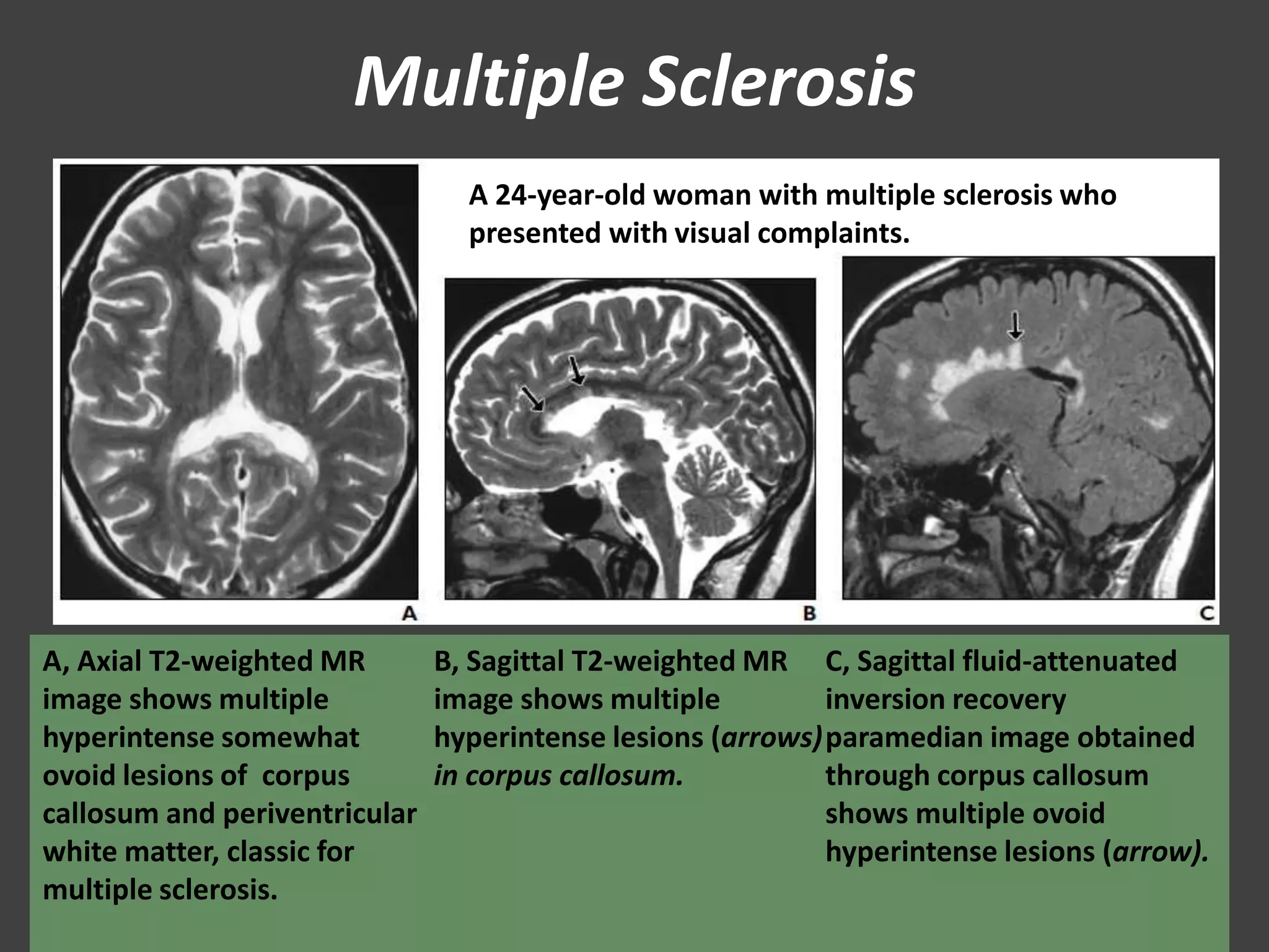 Disorders of corpus callosum | PPTX