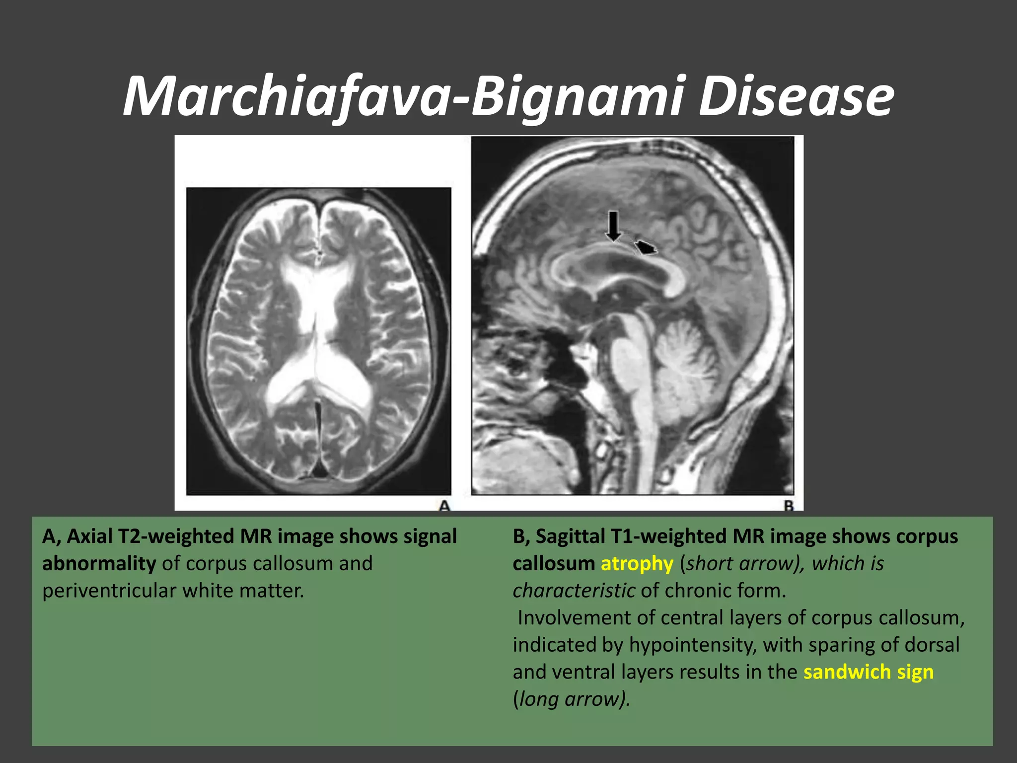 Disorders of corpus callosum | PPTX