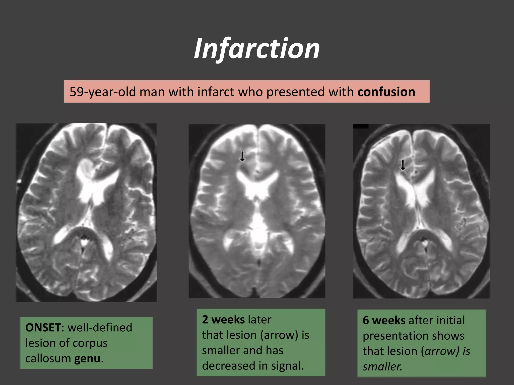 Disorders of corpus callosum | PPTX