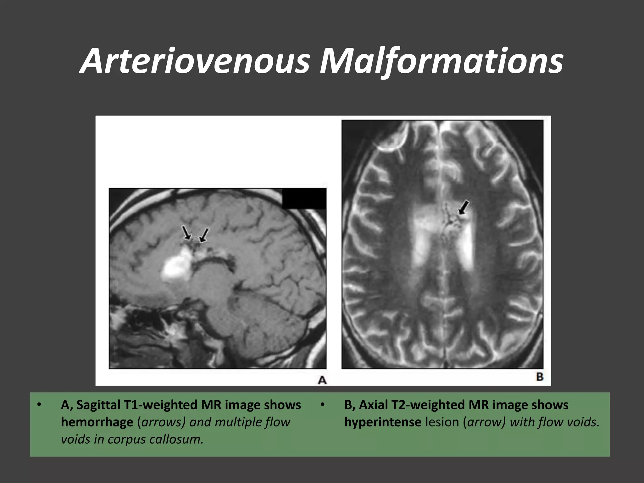 Disorders of corpus callosum | PPTX