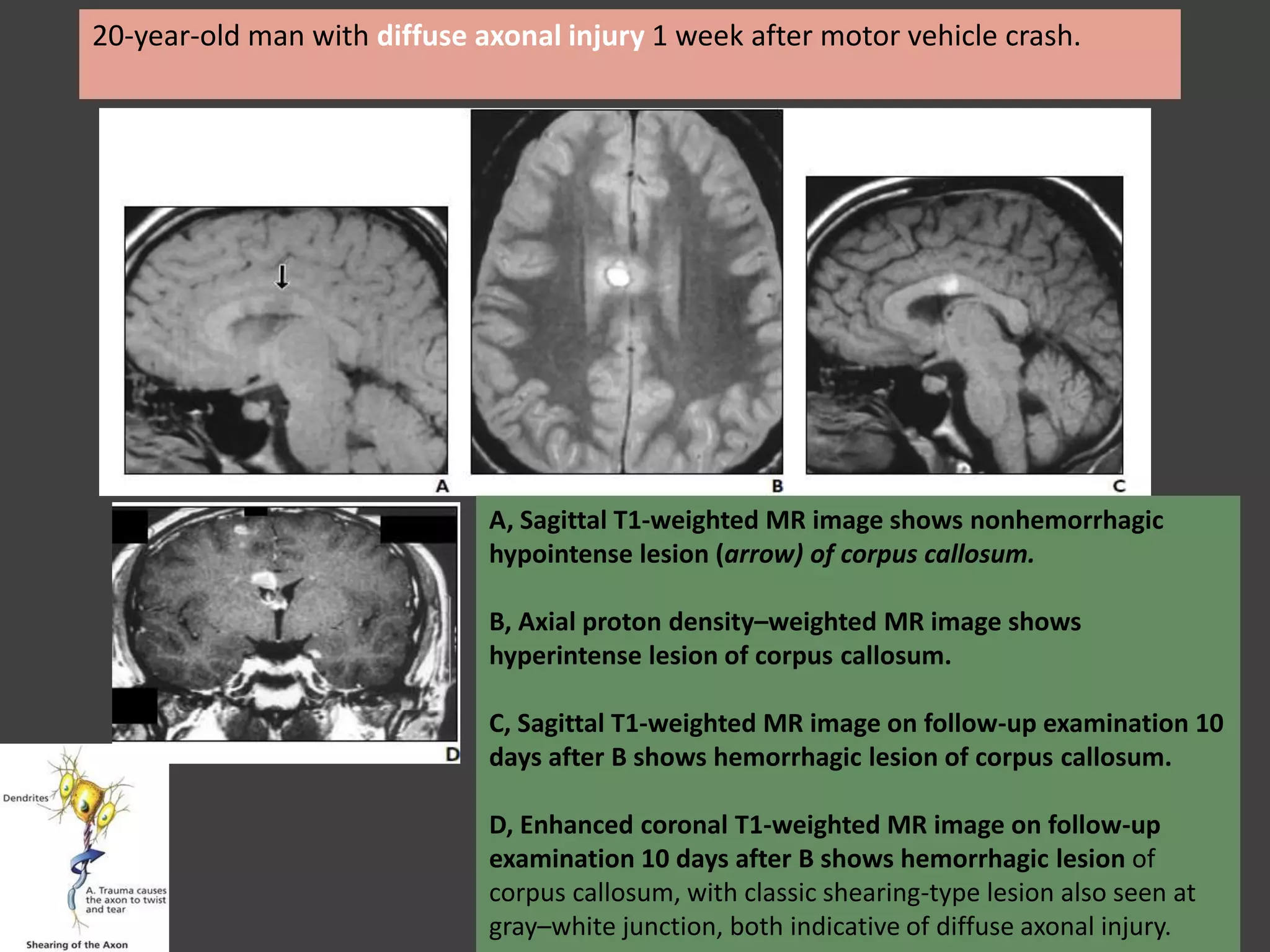 Disorders of corpus callosum | PPTX