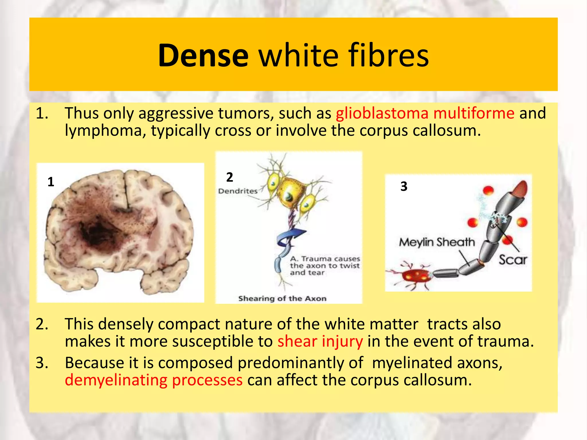 Disorders of corpus callosum | PPTX