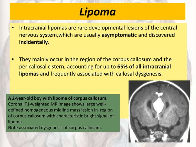 Disorders of corpus callosum | PPTX