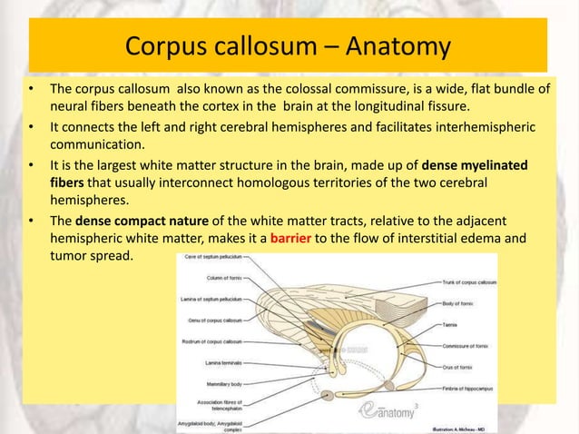 Disorders of corpus callosum | PPTX