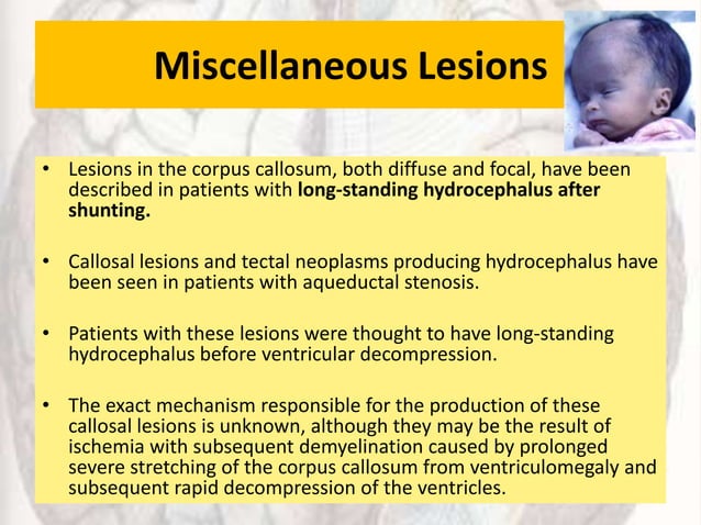 Disorders of corpus callosum | PPTX