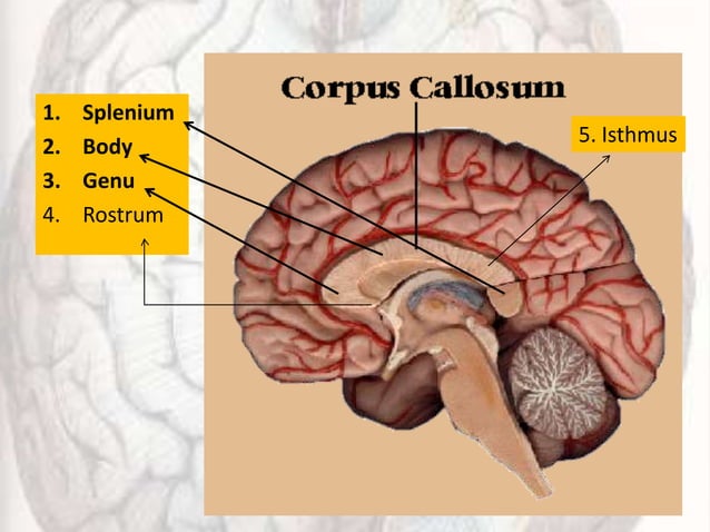 Disorders of corpus callosum | PPTX