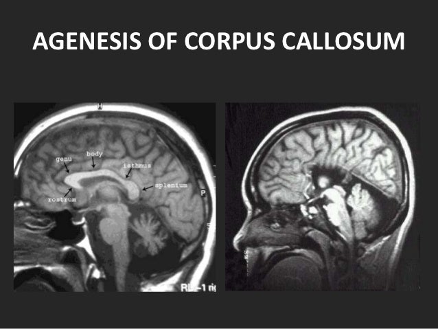 Disorders of corpus callosum